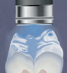 Fissure Sealants – Collins Dental Group